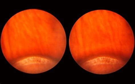 Lattice Degeneration Retina Image Bank