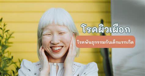 โรคผิวเผือก โรคถ่ายทอดทางพันธุกรรม ที่อาจเกิดกับเด็กแรกเกิด