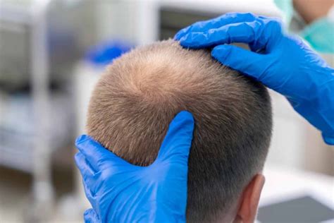 Saçkıran Nedir Tedavi Yöntemleri Nelerdir Hekimzade Blog