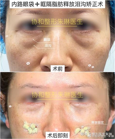 北京内路眼袋 眶隔脂肪释放泪沟矫正术 知乎