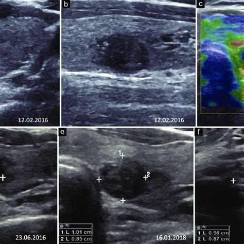 Baseline Usg A And B Showing The Hypoechoic Nodule In The Left