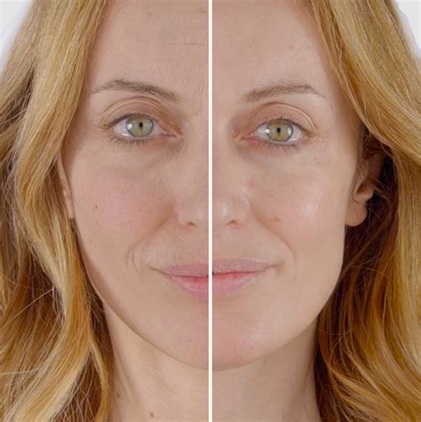 Biorivitalizzazione Viso Fai Da Te Come Farla