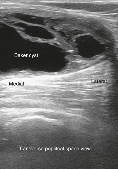 Injection Technique For Baker Cyst Clinical Tree