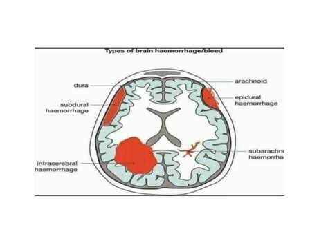 Tbi In Pediatrics Pptx