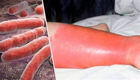 Erysipelas Infection Problems And Solutions Step To Health