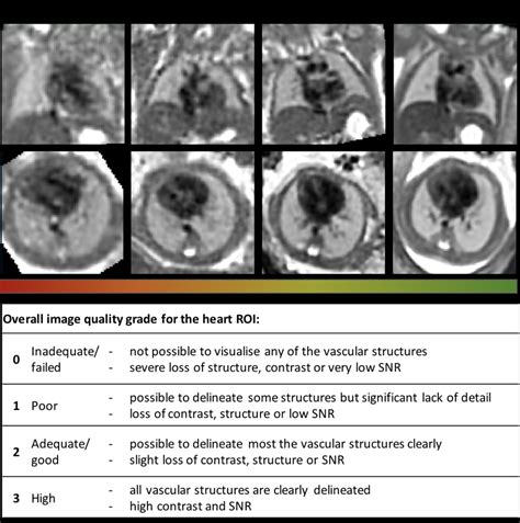 Fetal Thorax Reconstruction Quality Grading Scheme For The Heart Roi