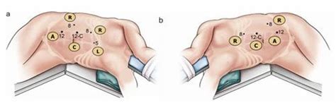 Robot Assisted Partial Nephrectomy In Kolkata Id 6880562533