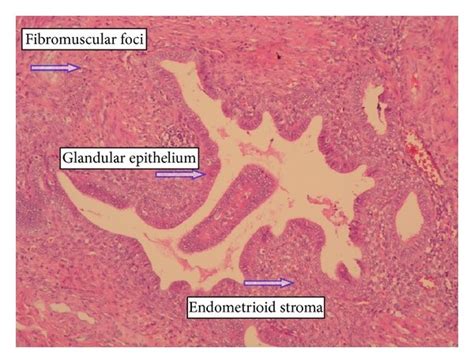 Appendix Wall Focusing On Endometriosis Inside Epithelial And Stromal