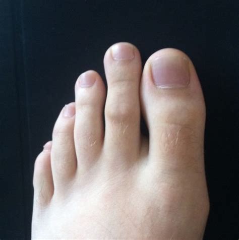 What Is Arthrodesis Toe How To Treat And Recover Arizona Foot