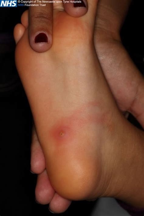 Jigger Flea Bites