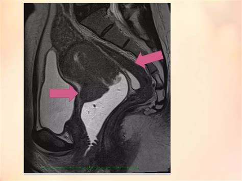 Urology Gynecology Mri Staging For Ca Cervix Ppt
