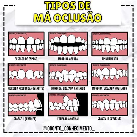 𝕺𝖉𝖔𝖓𝖙𝖔 𝖈𝖔𝖓𝖍𝖊𝖈𝖎𝖒𝖊𝖓𝖙𝖔 On Instagram “tipos De Má Oclusão A Má Oclusão é