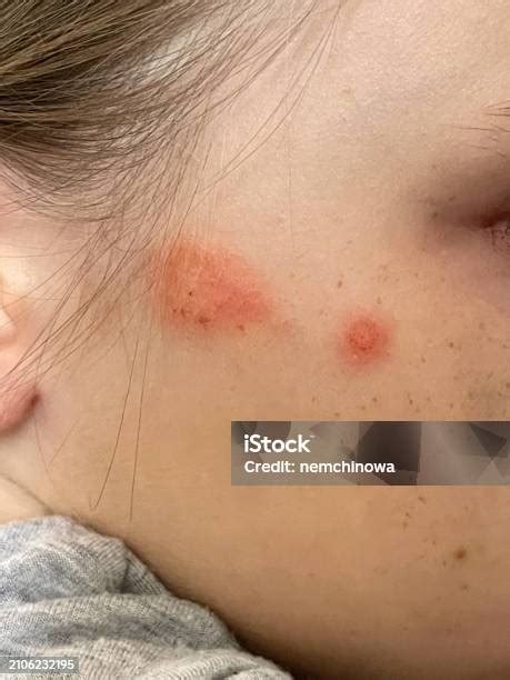 사람의 얼굴 클로즈업 피부 트러블이 있는 몸 전염병 알레르기 피부염 바이러스 또는 박테리아 감염 피부과 의학 및 건강 관리 개념
