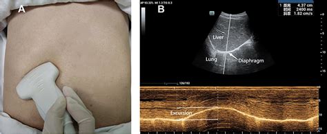 Diaphragm Assessment By Multimodal Ultrasound Imaging In Healthy Subje