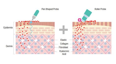 Electroporation Honolulu Beauty Clinic