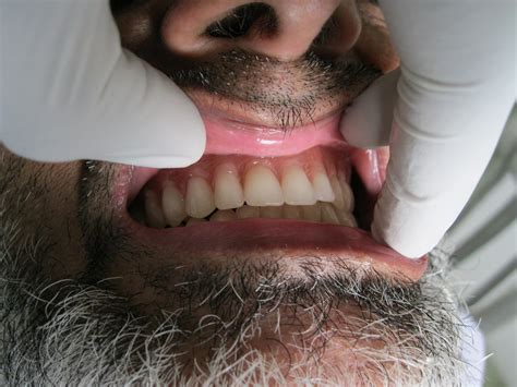 Dento Care Dental Clinics Sunflex Complete Denture