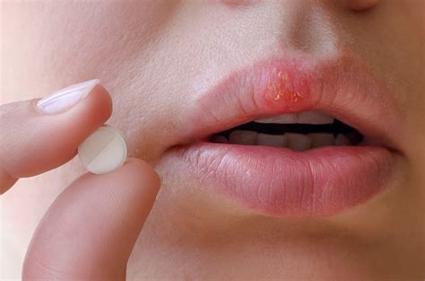 Aciclovir para que serve características e como usar Guia da Farmácia