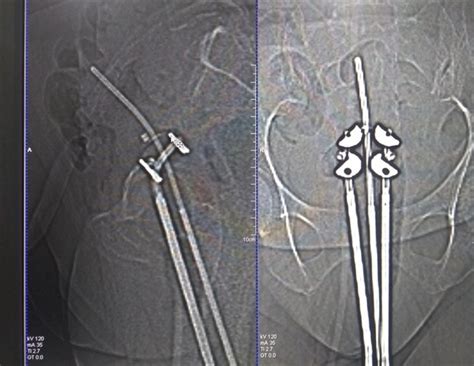 Brachytherapy For Prostate Cancer