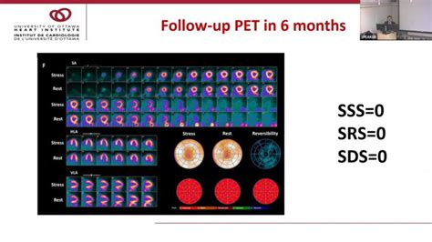 Coronary Microvascular Dysfunction And Role Of Multimodality Imaging