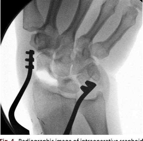 Figure 1 From Medial Femoral Trochlea Osteochondral Flap Applications