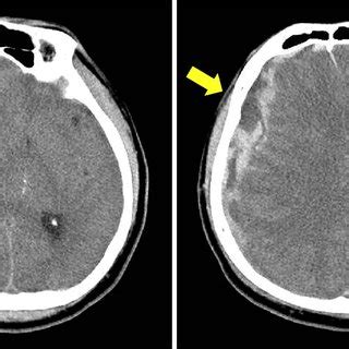 Diffusion Tensor Imaging DTI Tractograpy The Color Coding Of