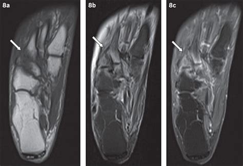 Magnetic Resonance Imaging Of Diabetic Foot Complications Smj