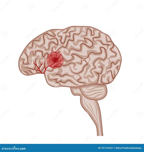 Cerebro Humano Enfermedades Del Cerebro Sistema Nervioso Ilustración