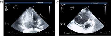 Tte Showing A Dilated And Dysfunctional Right Ventricle With A