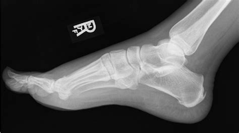 Figure 1 From Cuboid Dislocation Associated With A Central Column