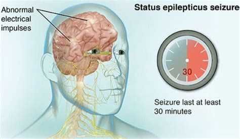 Status Epilepticus Treatment
