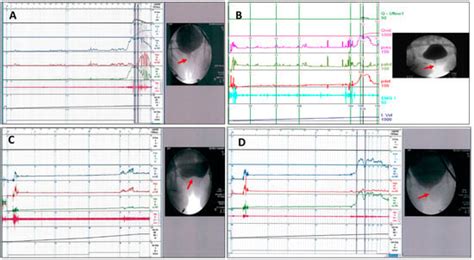 Predictive Factors For The Successful Outcome Of Urethral Sphincter Injections Of Botulinum