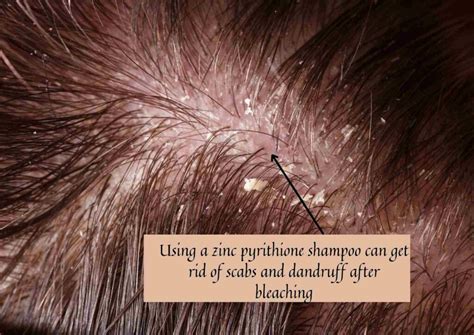 6 Tips On How To Treat Scabs On Scalp From Bleach 2026 Treatments Fo