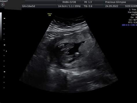 Gender Scan Mumsnet