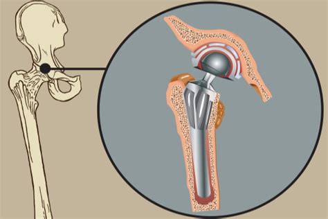 Gentle Surgery Methods Make Hip Replacement Less Challenging