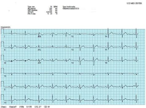 Endocarditis Ecg