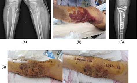 A Severe Proximal Tibia Fracture Is In Severe Soft‐tissue Swelling And Download Scientific
