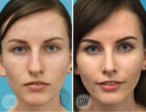 Prominent Nose Bridge 5 Best Steps How To Lift Your Nose Bridge
