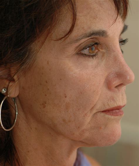 Hetter Chemical Peel Resurfacing St Petersburg And Clearwater