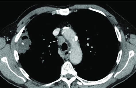 Contrast Enhanced Ct Scan Of The Chest Obtained At The Level Of Aortic
