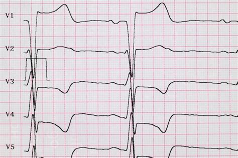 Premium Photo Ecg Myocardial Infarction On Ecg Subendocardial