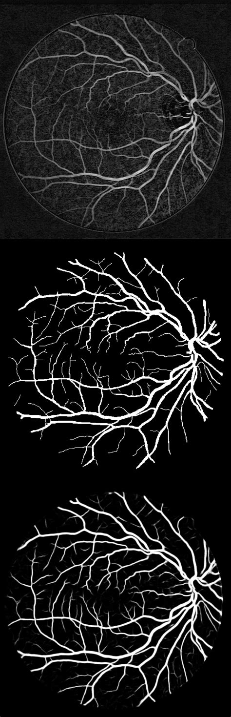 Segmented Result Of Test Images From Drive Dataset A Preprocessed