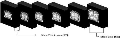 Stacks Of Slices Denoting Slice Thickness ST And Slice Gap SG