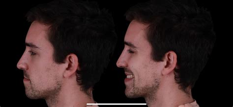 Worried About Mandibular Setback R Jawsurgery