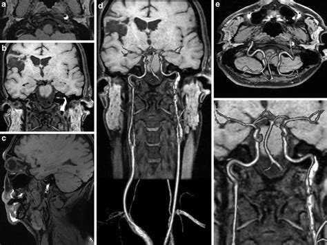 Carotid Artery Dissection Radiology Key
