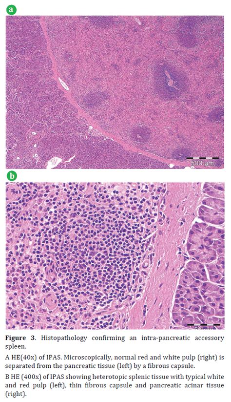 Intrapancreatic Accessory Spleen A Differential Diagnosis To Neu