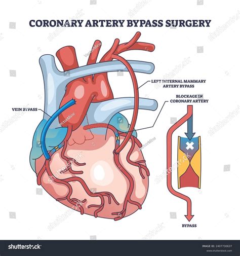 Coronary Artery Bypass Surgery Port