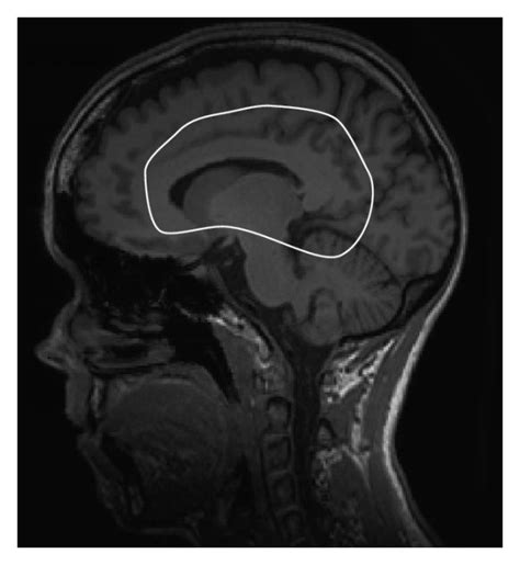 Segmentation Of The Brain Surface Using Deformable Models A A Closed Download Scientific