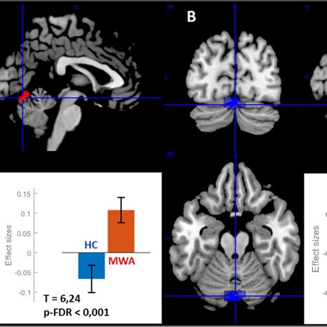Increased Connectivity Between Roi 1 Antero Dorsal Insula Right A
