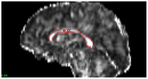 Mid Sagittal Slice Showing Tracing Of The Whole Corpus Callosum Download Scientific Diagram