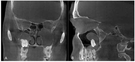 Management Of Odontogenic Sinusitis Results With Single Step Fess And